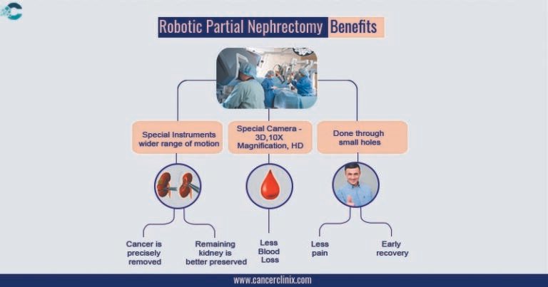 Benefits of Robotic Partial Nephrectomy for Kidney tumour - Cancerclinix