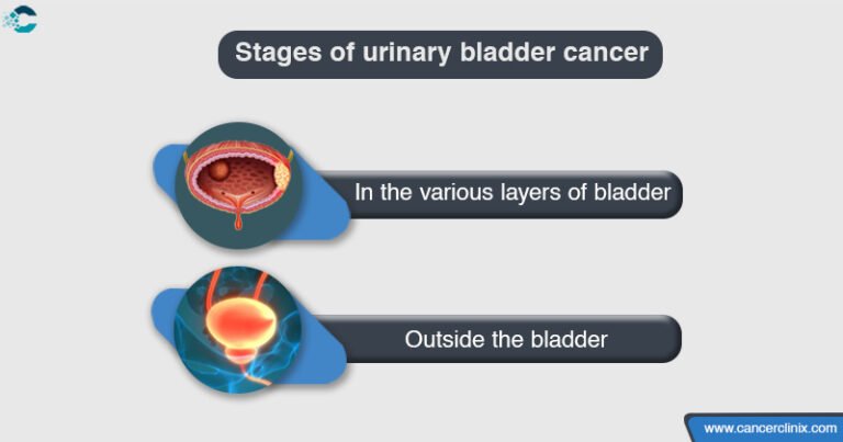 Urinary Bladder Tumour Surgery is done for these SYMPTOMS - Cancerclinix