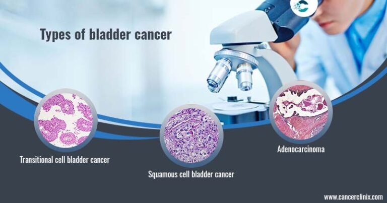 Incidence of Bladder Cancer Surgery in Ahmedabad is increasing ...