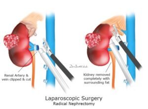 Laparoscopic Kidney Cancer Surgery is done through small holes ...